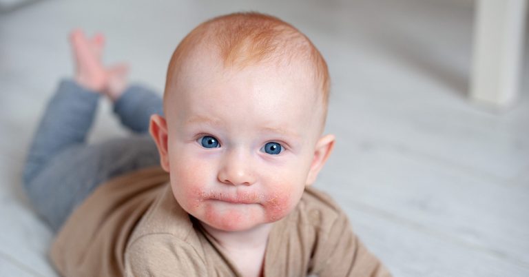 Teething Rash: What is it and How To Treat It - St. Johns Pediatric ...